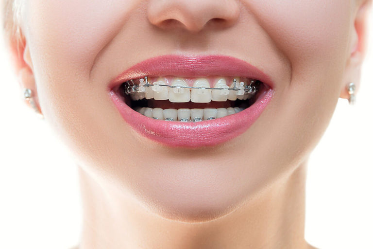 How Much Does It Cost To Get Braces The Frisky How Much Does It Cost To Get Braces The Frisky