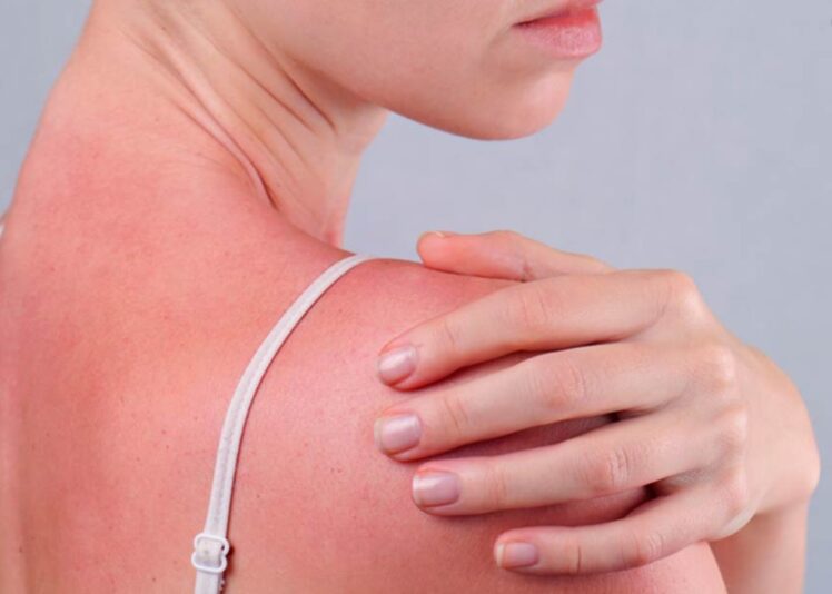 8 Ways to Maintain a Healthy Skin After Sun Exposure - The Frisky