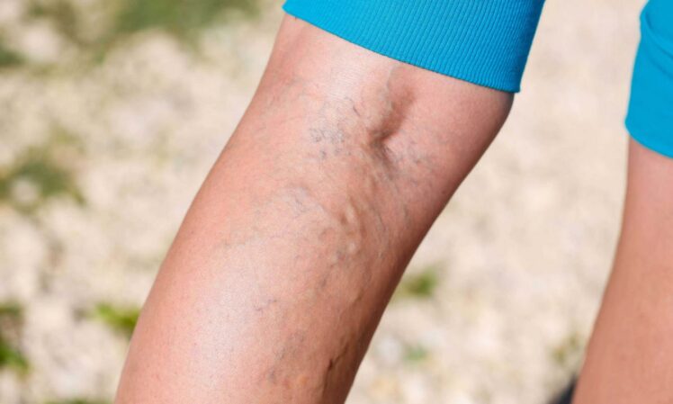 Venous Insufficiency – Causes, Symptoms, and Diagnosis - The Frisky