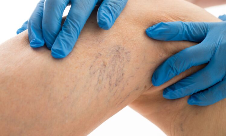 Venous Insufficiency – Causes, Symptoms, and Diagnosis - The Frisky