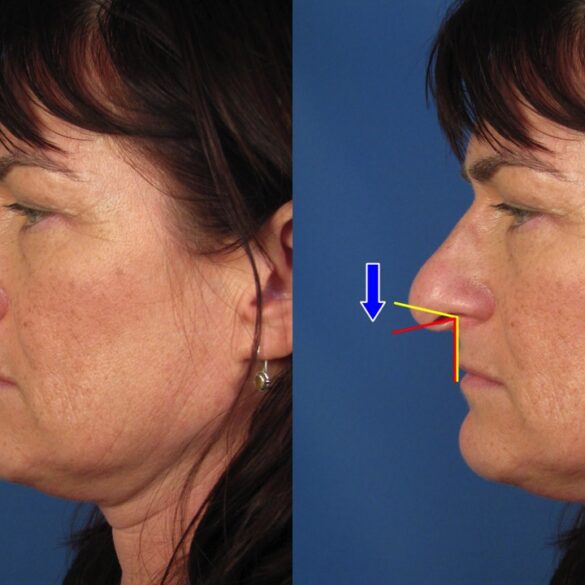 Samuel Lin, MD FACS Discusses Functional vs. Aesthetic Rhinoplasty ...