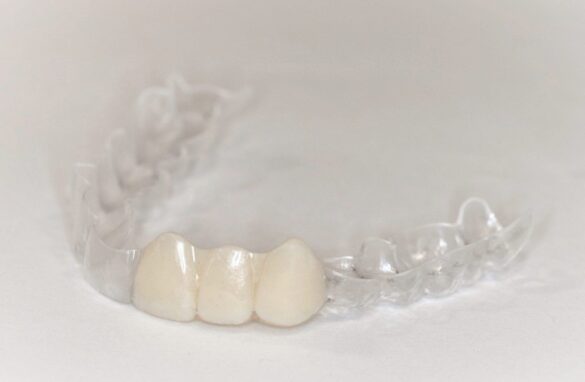 4 Things To Know Before Buying Dental Retainers Online - 2024 Guide ...