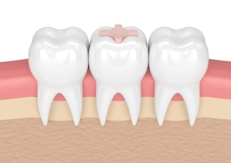 Your Guide To The 5 Different Types of Dental Filling - The Frisky