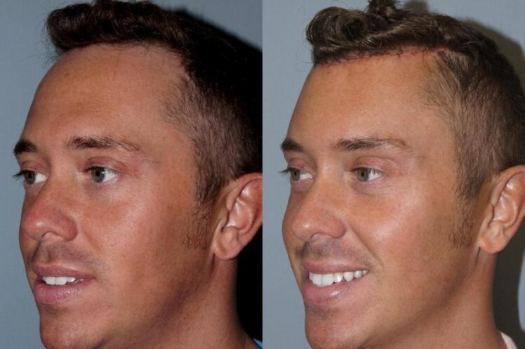 Life-Changing Forehead Reduction - The Frisky