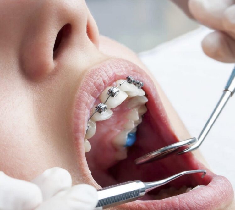 Your Definitive Guide to Metal Braces - The Frisky