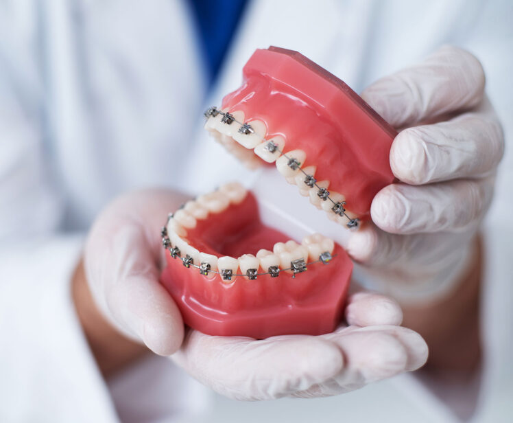 Your Definitive Guide to Metal Braces - The Frisky