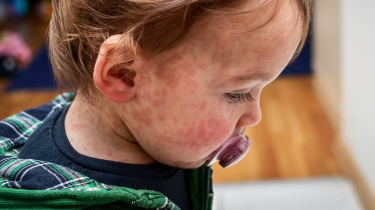 Managing Allergies in Children: A Comprehensive Guide for Parents - The ...