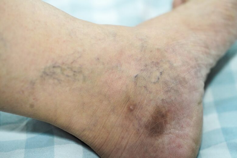 6 Warning Signs of Venous Insufficiency You're Probably Mistaking for ...